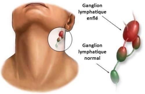 Ganglion Mastoidien Gonfl Gonflement Des Ganglions Et Douleur ZZGH Ganglion Mastoidien Gonfl Gonflement Des Ganglions Et Douleur ZZGH