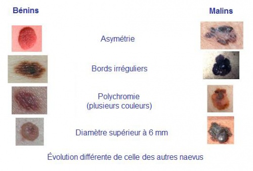 Tout Savoir Sur Le Grain De Beauté Améliore Ta Santé
