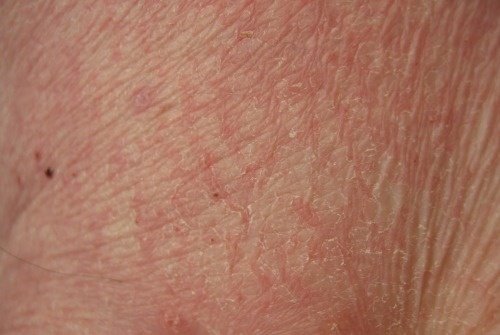 Éruption cutanée : traitements naturels - Améliore ta Santé