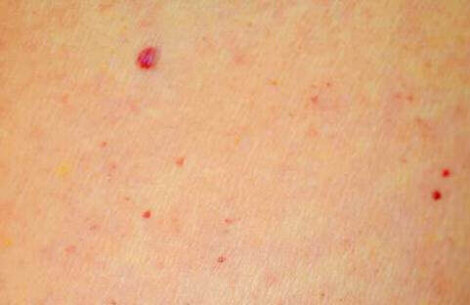 Points rouges sur la peau : faut-il s'inquiéter ? - Améliore ta Santé