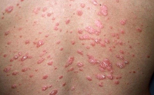 Les différents types de psoriasis - Améliore ta Santé