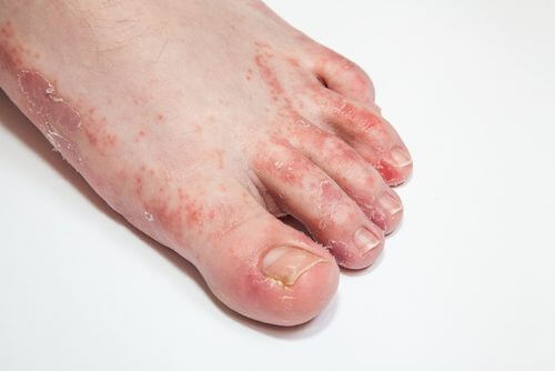 Mycoses sur les pieds ? 3 remèdes pour les éliminer définitivement ...