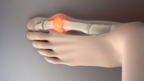 8 aliments pour diminuer les niveaux d'acide urique - Améliore ta Santé