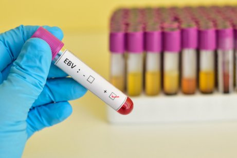 La mononucléose infectieuse - Améliore ta Santé