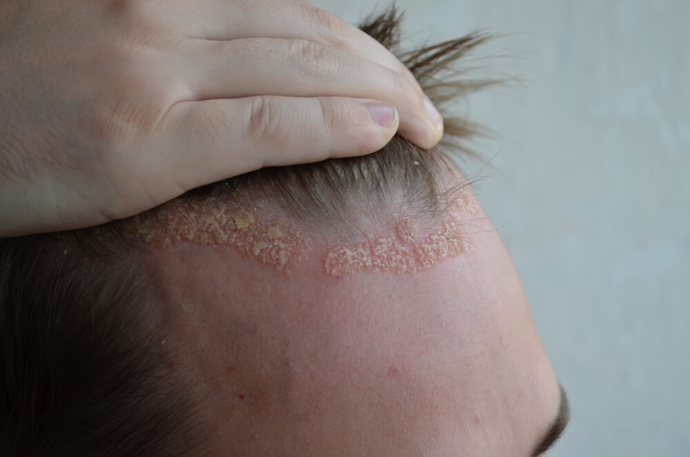 5 remèdes faits maison pour soulager le psoriasis du cuir chevelu ...