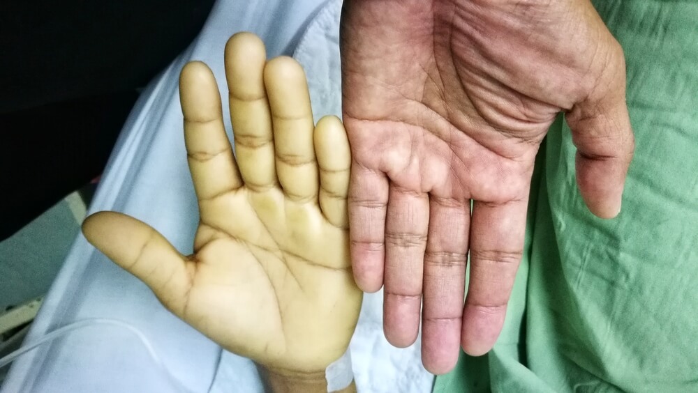 Anémie en fer : les recommandations alimentaires - Améliore ta Santé