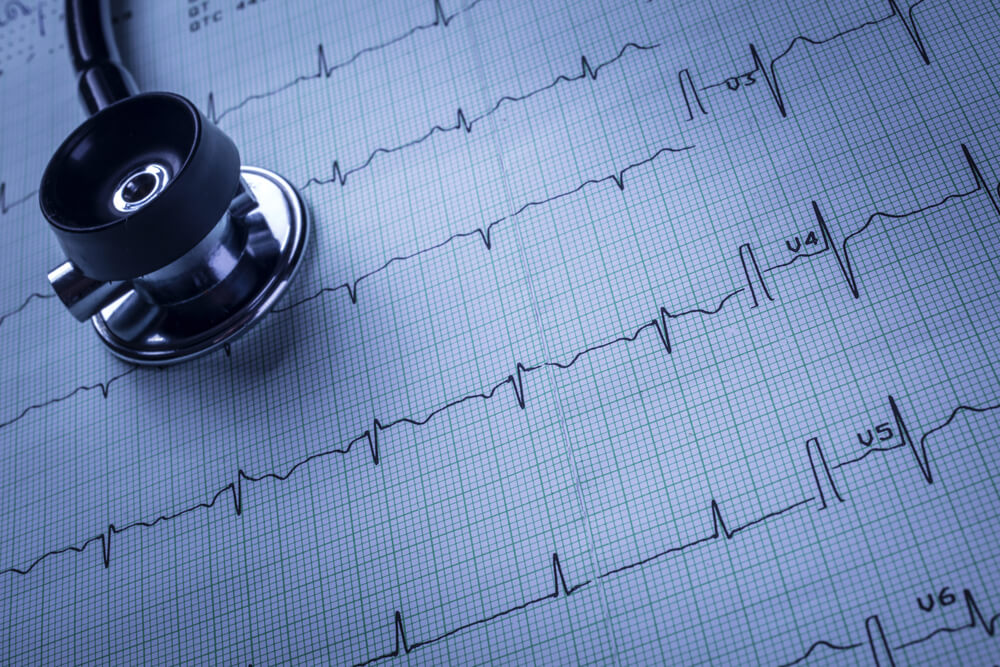 Les 7 étapes pour interpréter un électrocardiogramme - Améliore ta Santé