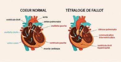 La cardiopathie congénitale - Améliore ta Santé