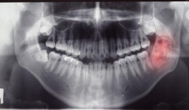 Diagnostic des tumeurs et kystes de la mâchoire - Améliore ta Santé