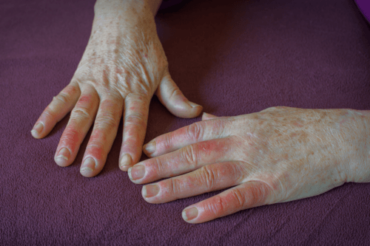 Maladie de Raynaud : symptômes, diagnostic et traitement