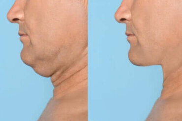 5 exercices pour avoir une mâchoire sculptée